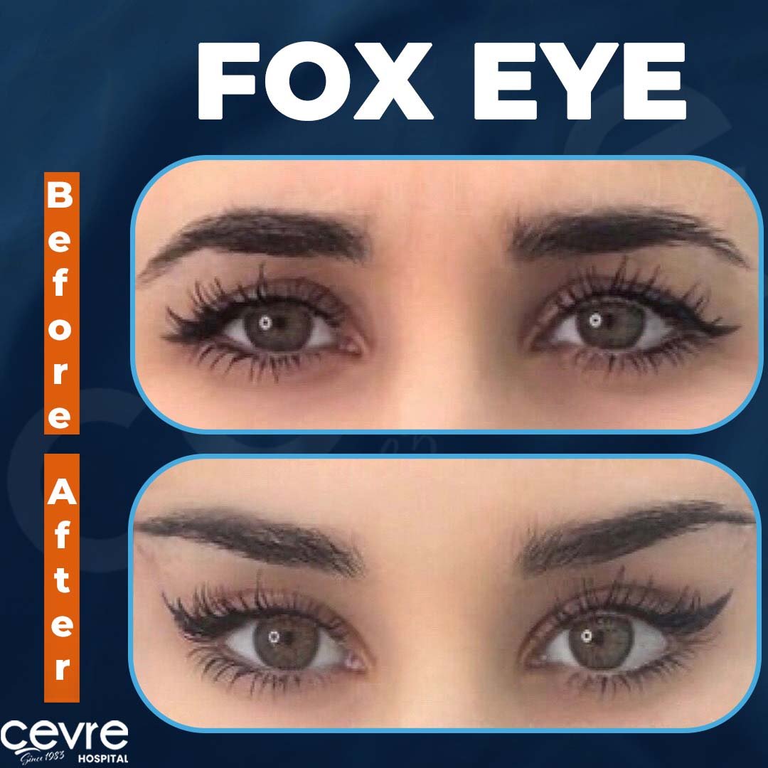 2024 Fox Eye Lift in Istanbul, Turkey: Cost and Updates!
