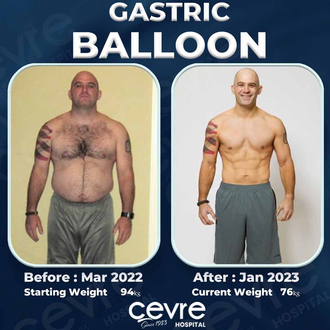 2024 Gastric Balloon in Istanbul, Turkey | Cevre Hospital