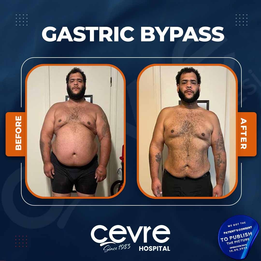 2024 Gastric Bypass in Istanbul, Turkey | Cevre Hospital