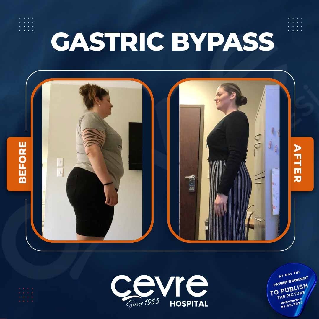 2024 Gastric Bypass in Istanbul, Turkey | Cevre Hospital