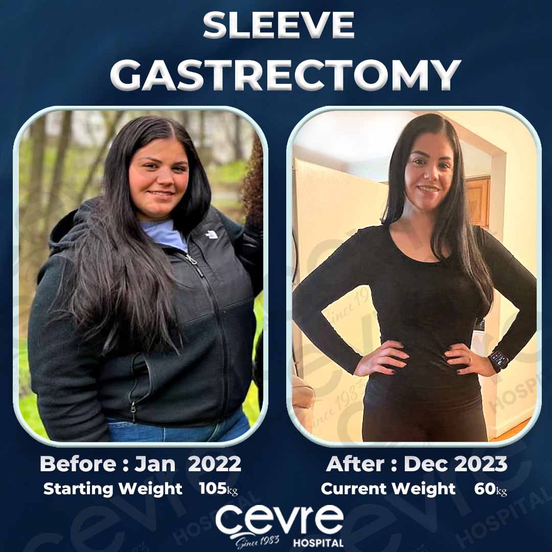 2024 Gastric Sleeve Surgery in Turkey Cost | Cevre Hospital