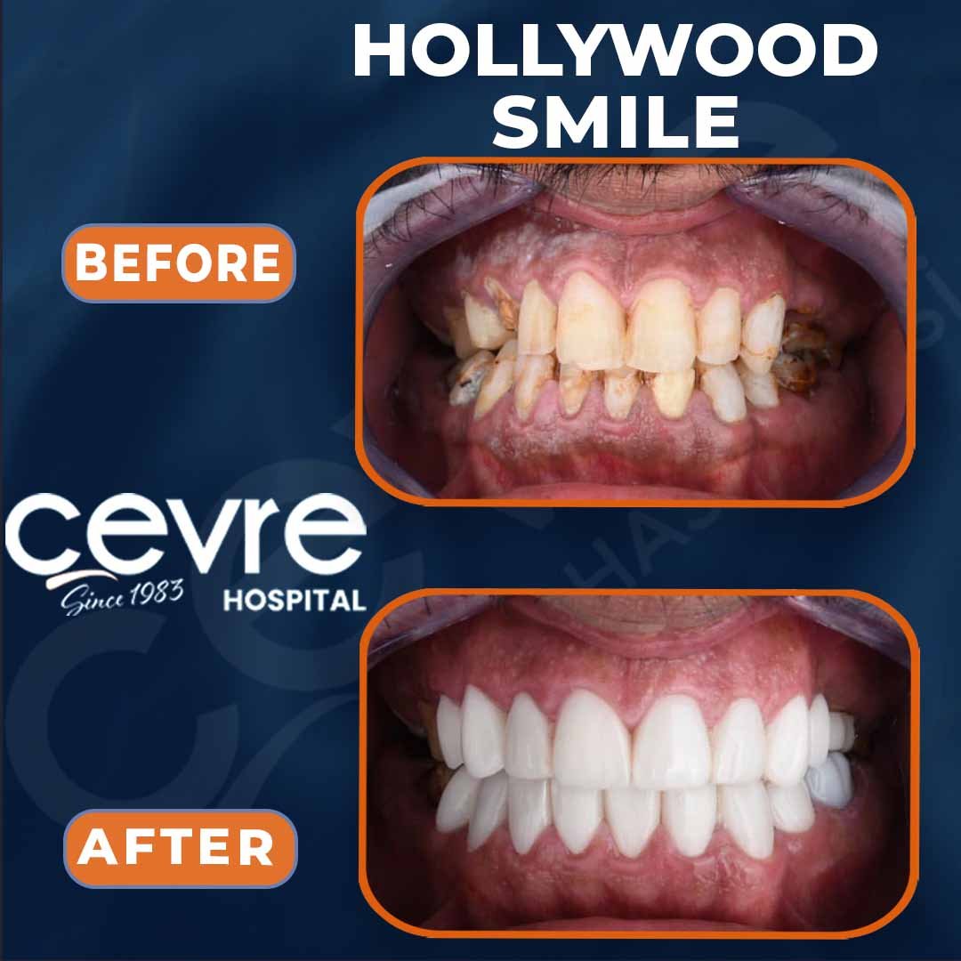 2024 Hollywood Smile in Istanbul, Turkey: Cost and Updates!