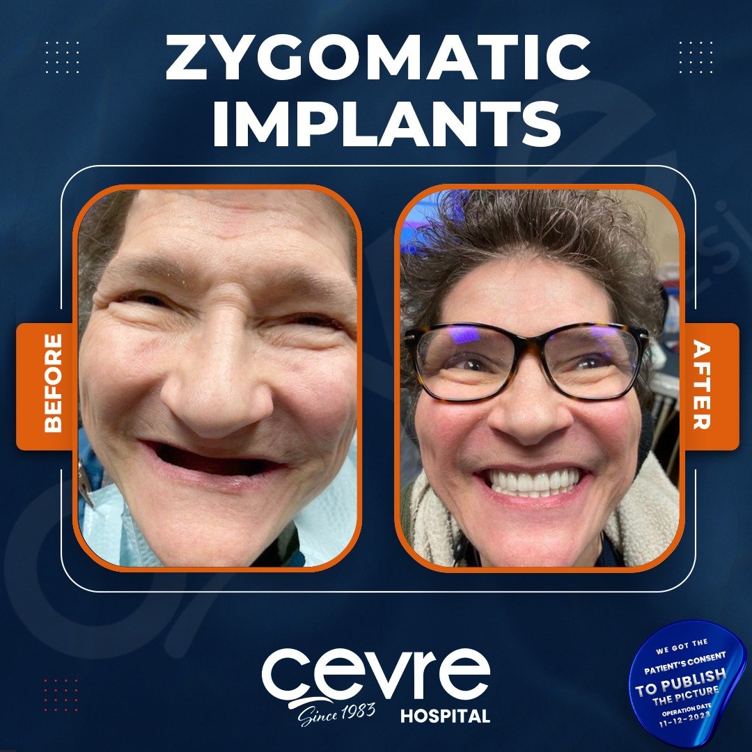 2024 Zygomatic/Zygoma Implants in Istanbul, Turkey: Cost and Updates!