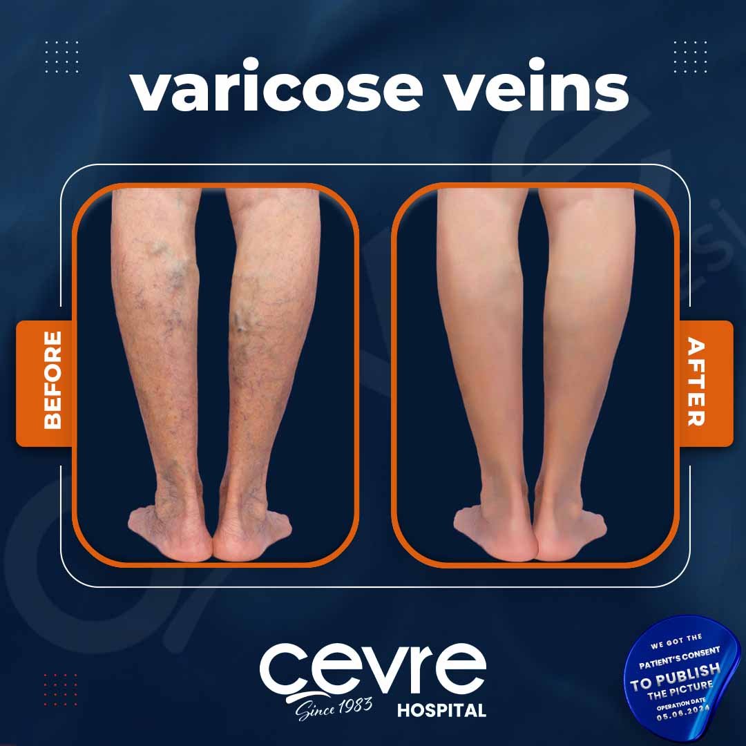 2024 Varicose Veins Treatment in Istanbul, Turkey | Cevre Hospital