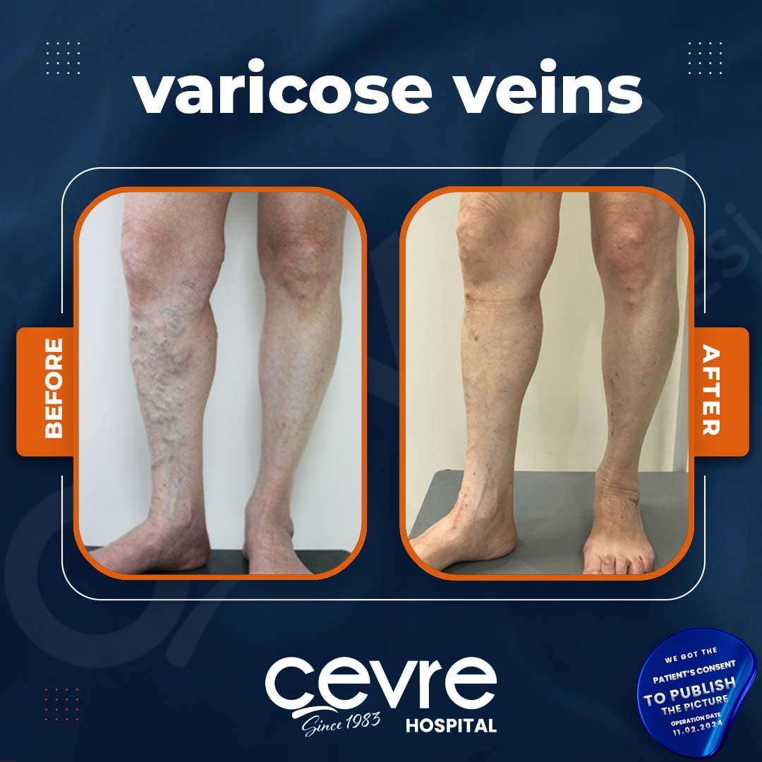 2024 Varicose Veins Treatment in Istanbul, Turkey | Cevre Hospital