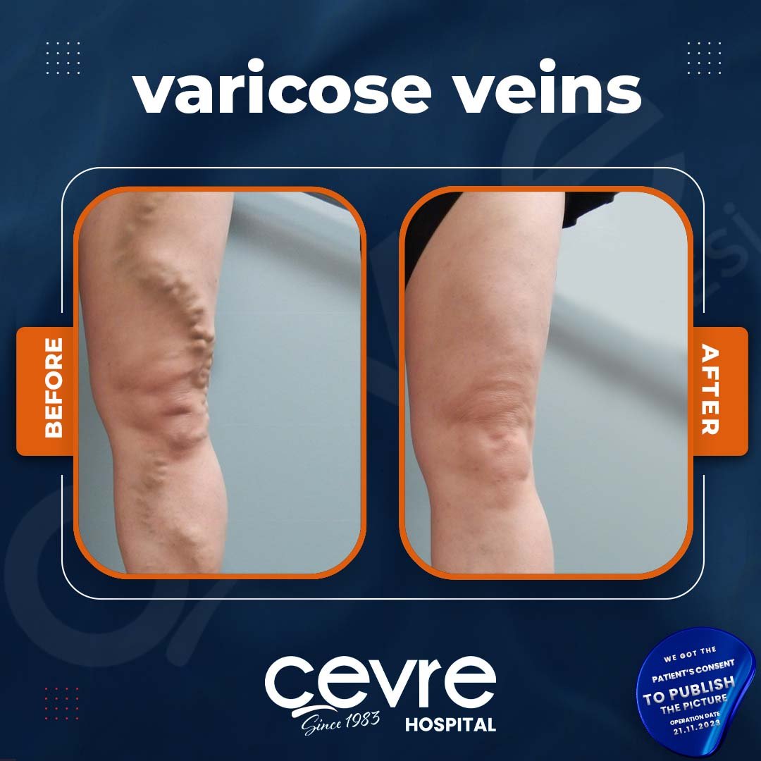 2024 Varicose Veins Treatment in Istanbul, Turkey | Cevre Hospital