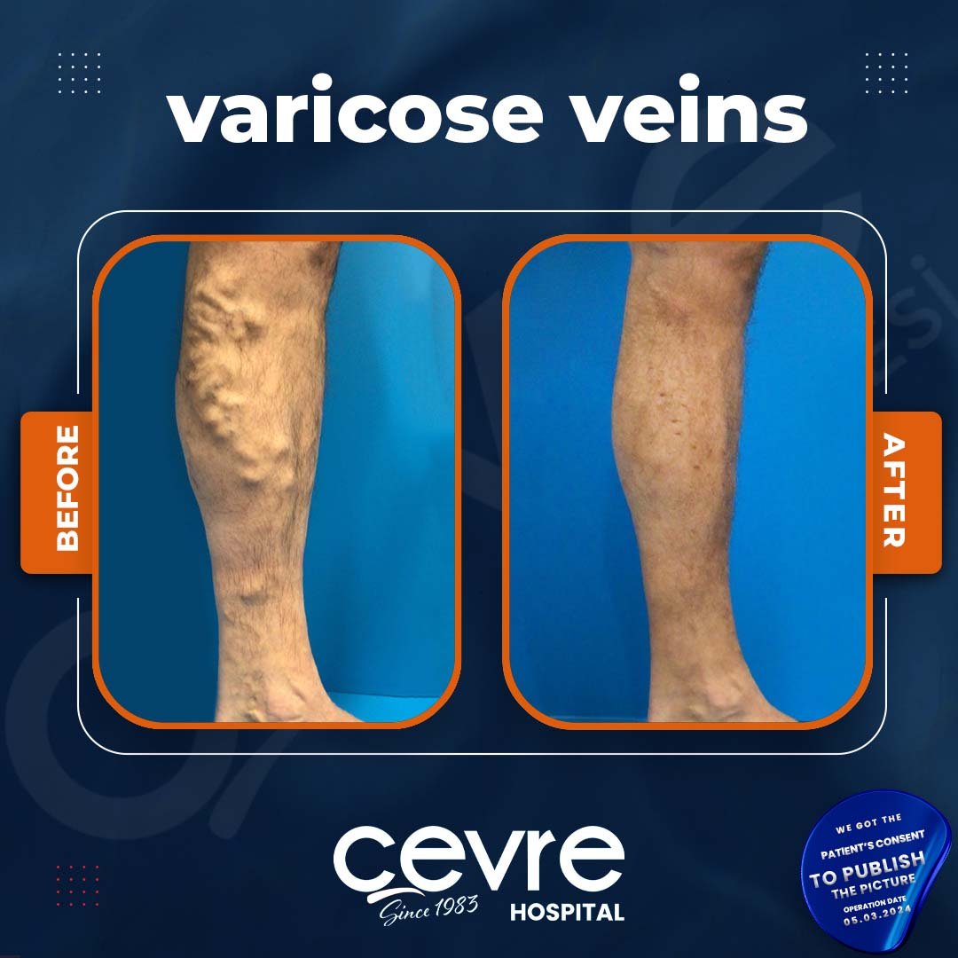2024 Varicose Veins Treatment in Istanbul, Turkey | Cevre Hospital